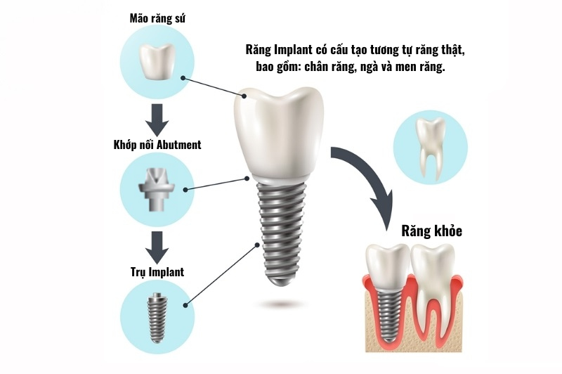 DISCOVER THE MOST POPULAR DENTAL IMPLANT TECHNOLOGY TODAY - IKALAB ...